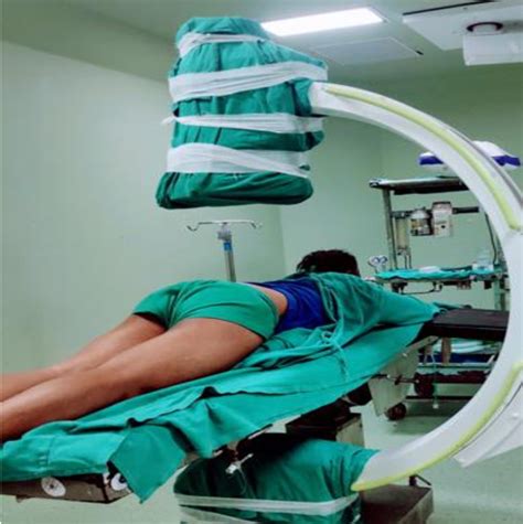 Figure 1 From Outcome Of Transforaminal Nerve Root Block Using Posterolateral Approach In