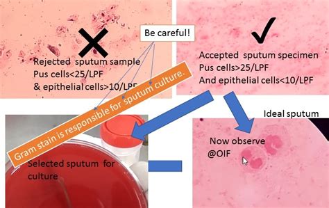Ideal Sputum Specimen Introduction Selection And Rejection Criteria