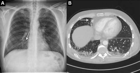 Ai Accurately Identifies Normal And Abnormal Chest X Rays Hale Plus