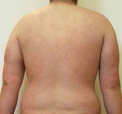 Arthropathic Psoriasis Complicated By A Paradoxical Reaction In The