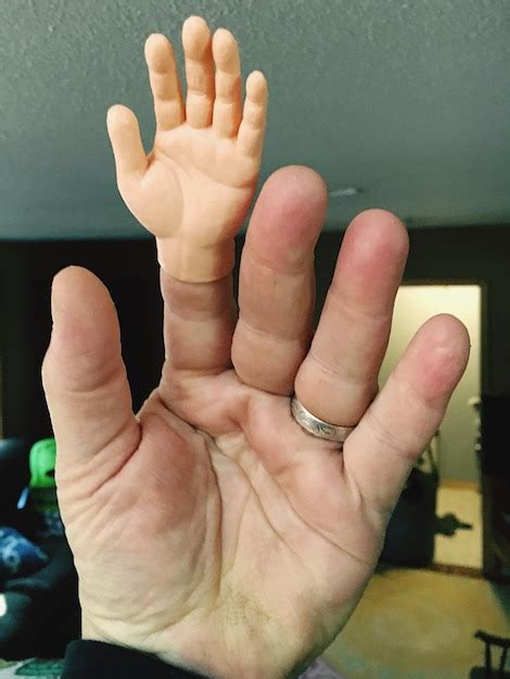 93000 Trigger Finger Disease Pictures
