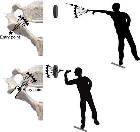 Concept Of The C Arm Cbct Guided Cps Placement Technique Download