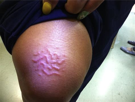 Under Skin Parasites Us Slowly Getting Caught In Proliferating