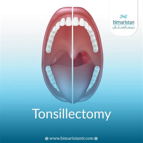 Tonsillectomy And Its Benefits In Turkey Bimaristan