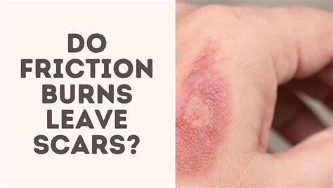 What Do Friction Burns Look Like At Caitlyn Adam Blog