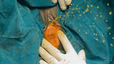 Urinary Incontinence Surgery India Türkçe