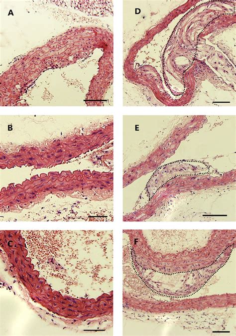 The Hande Staining Of Apoe À À Mice Paraffin Sections Of Aorta 1 A And Download Scientific