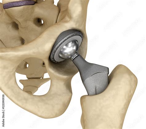 Hip Replacement Implant Installed In The Pelvis Bone Medically
