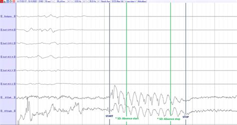 Example Of An Algorithm‐detected 3‐hz Spikewave Discharge Of ≥3 S On Download Scientific