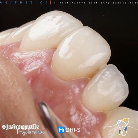 Anterior Aesthetics The Complete Composite Guide — Explore Dentistry