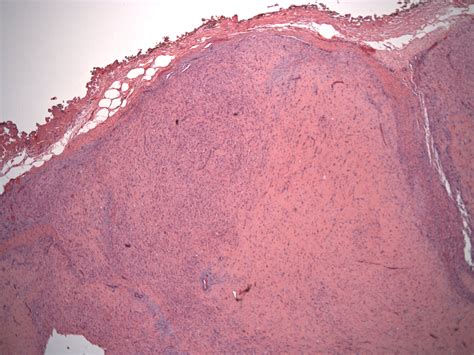 Pathology Outlines Proliferative Fasciitis