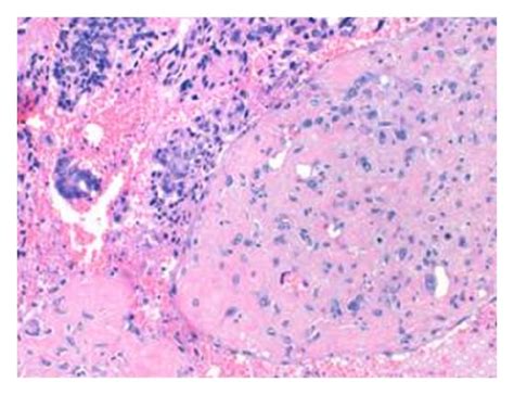 Sarcomatoid Carcinoma Of The Prostate Ductal Adenocarcinoma And