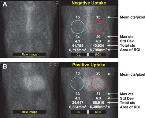 99mtc Pyrophosphate Scintigraphy For Differentiating Light Chain