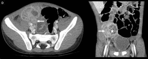 Perforated Appendicitis Image 3 Ct Ultrasound In Resource Limited