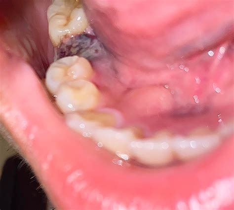 White Stuff On Tooth Extraction Site Raskdentists