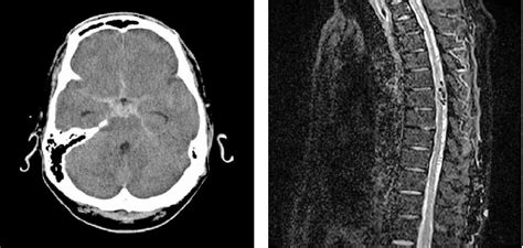 Axial Ct Brain Image Shows Subarachnoid Haemorrhage Centred At The