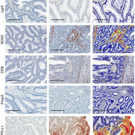 Low And High Immunostaining Of Lgr5 Sox2 Cd8 Foxp3 And Pd L1 With