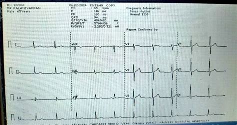 St Elevation On Tmt Without Prior Mi Double Vessel Disease And Ptca Case
