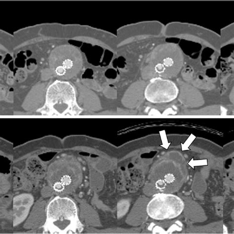 Serial Computed Tomography Ct Image Of Aortic Aneurysm Follow Up A