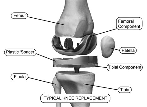 Illustration Of Typical Knee Replacement Hardware Components Re Hip And Knee Handbook Of