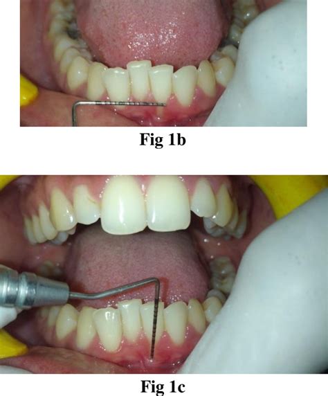 Figure 1 From Management Of Multiple Mucogingival Defects By Way Of Versatile Free Gingival