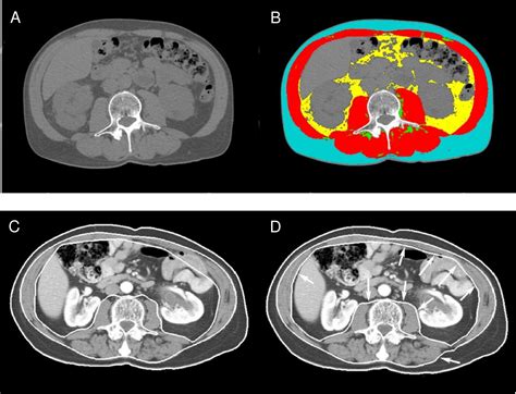 Machine Learning In Body Composition Analysis European Urology Focus
