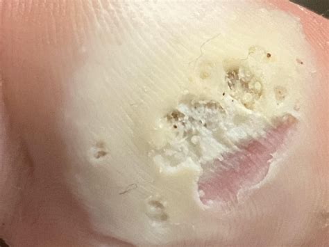 Mosaic Wart I Think Rwarts