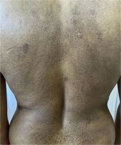 Case For Diagnosis Ichthyosiform Mycosis Fungoides Anais Brasileiros