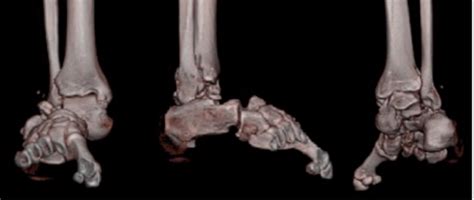 Subtalar Dislocations Are Divided Into Medial Lateral And Download Scientific Diagram