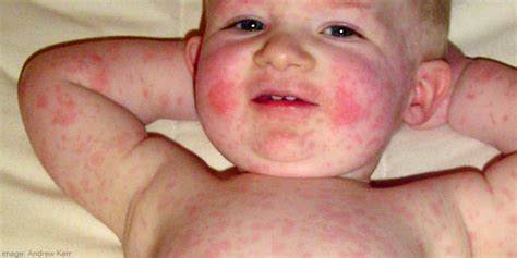 هل تعرف ما هو المرض الخامس واعراضه ؟؟ Fifth Disease ~ كل يوم دواء