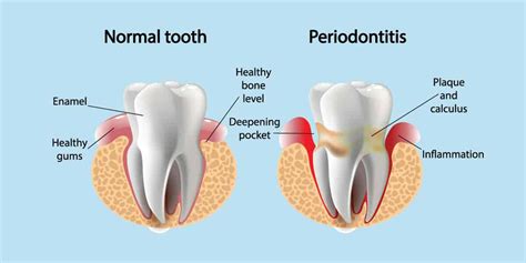 10 Important Points About Periodontal Pocketing