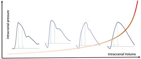 Intracranial Pressure Waveform Note Brasil S Et Al 2021 Were