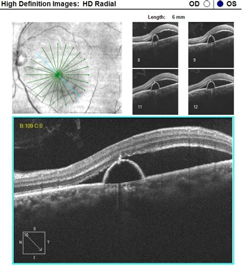 Cscr With Ped Defect Retina Image Bank