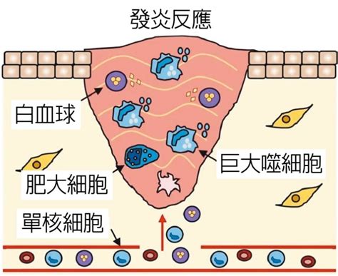 運動傷害先冰敷？醫曝研究發現：當心阻礙發炎反應、適得其反 健康遠見