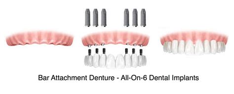 Bar Attachment Denture All In 4 Or 6 Pacific Oral Surgery