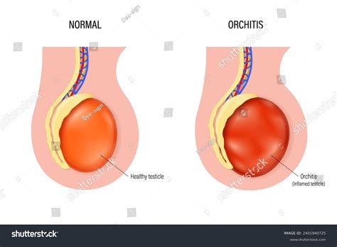 Orchitis Vector Comparison Normal Testicle Orchitis Stock Vector