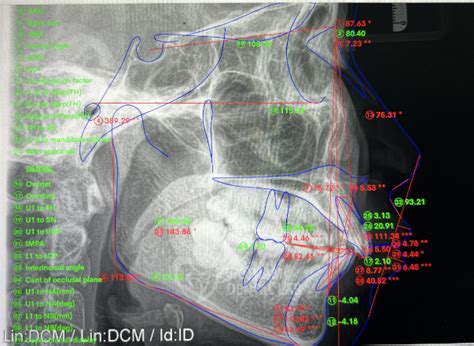 Additional Implants Surgical Guide Design Services Vietnam Dental Lab