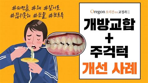 개방교합과 주걱턱 치아교정만으로 개선된 사례 【강남치아교정 오리건치과】 Youtube