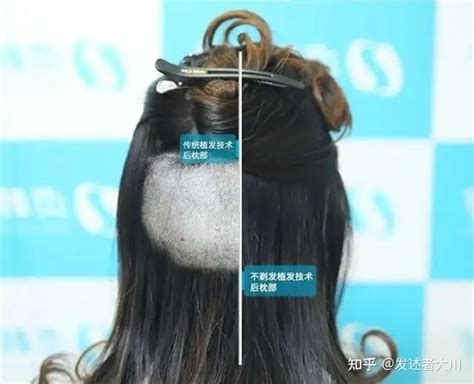 植发2年，劝你别轻易做植发 分析宝石刀、微针、种植针等植发器械哪种毛囊成活率高，雍禾 碧莲盛 熙朵 中德植发哪家效果好 知乎
