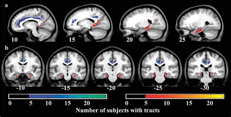 Functional Connectivity Magnetic Resonance Imaging Semantic Scholar