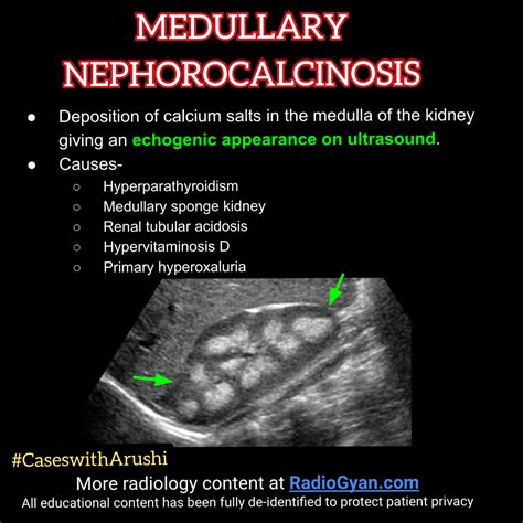 Medullary Nephrocalcinosis Radiology Ultrasound Technician