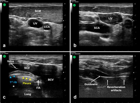 Ultrasound Guided Subclavian Vein Catheterization Using The Long Axis