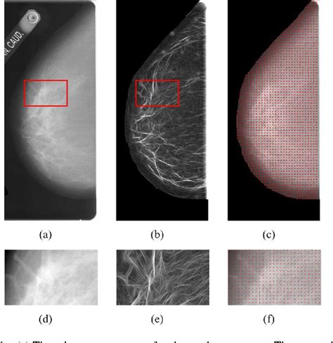 Figure 1 From Detection Of Architectural Distortion In Prior Mammograms Semantic Scholar