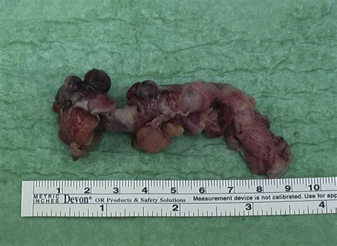 Specimen Of Normal Appendix With Inflamed Diverticula Download Scientific Diagram