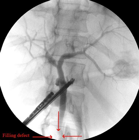 Laparoscopic Choledochoscopy For Choledocholithiasis Is Possible In The Anatomical Anomaly Of