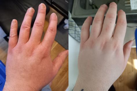 Massive Effect Of Cushings On Skin Thin Skin Red Dry Less Collagen