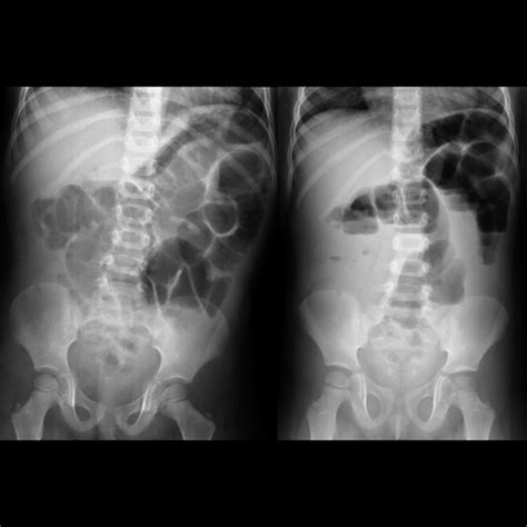 Pediatric Small Bowel Obstruction Pediatric Radiology Reference