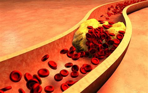 Arterial Embolism Iran Health Tourism Organizer Iran Medical