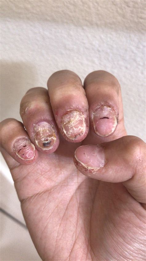 Dyshidrosis Has Ruined My Nails Pt2 Scrolller