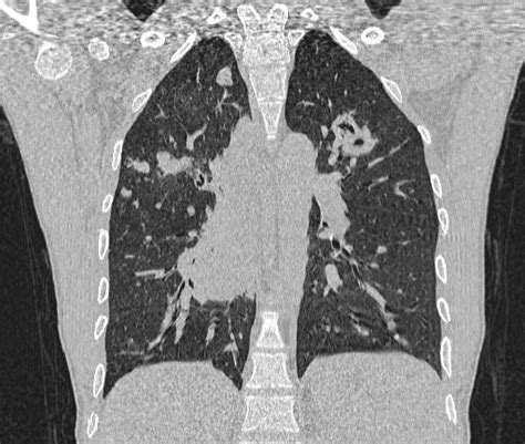 Pulmonary Cystic Echinococcosis Mimicking Metastatic Malignancy Eurorad